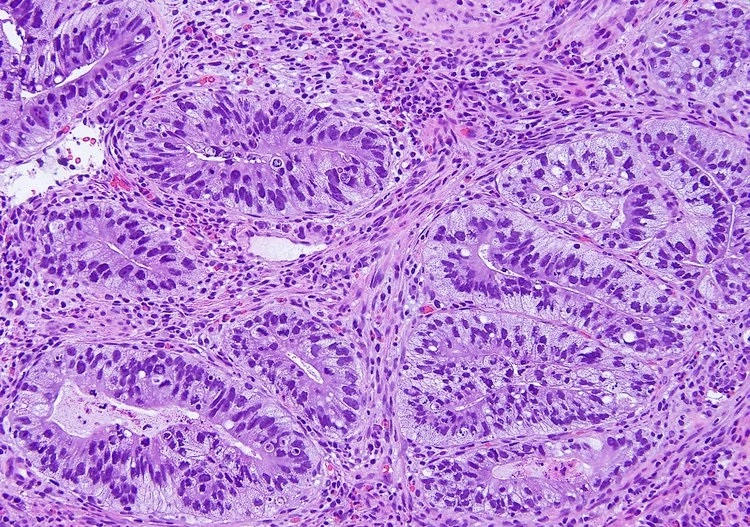 Аденокарцинома легкого: прогноз, стадии, классификация, диагностика и ...